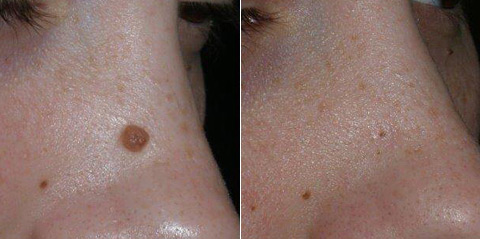 Entfernen von Muttermalen Prag (Tschechien) | Brandeis Clinic